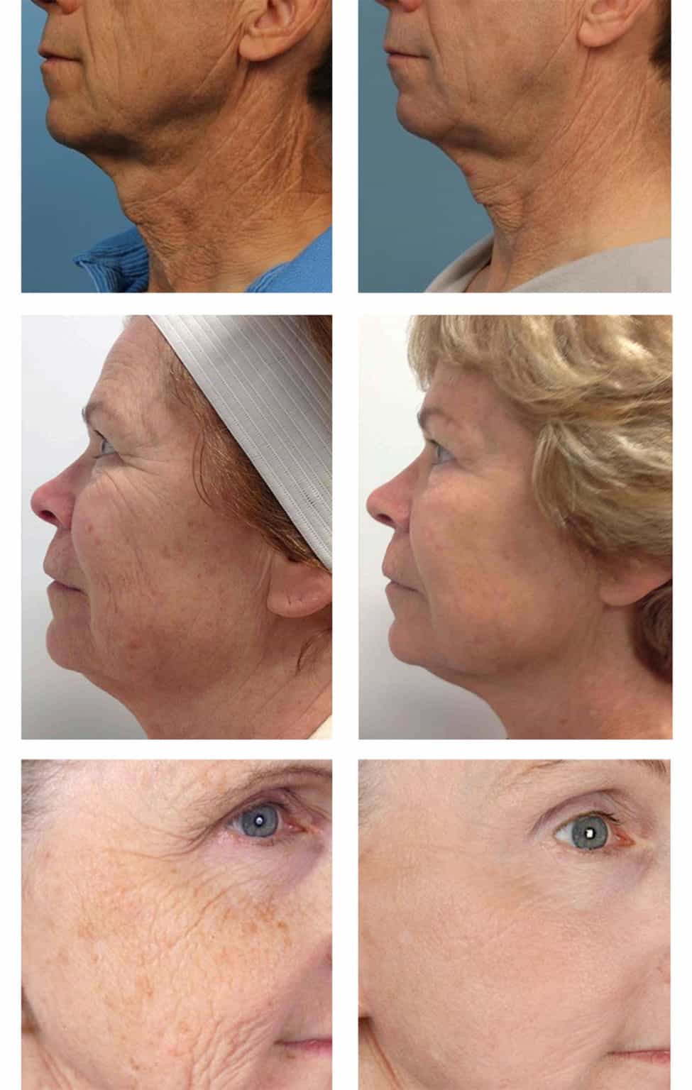 INFINI Treatment | Arion Skin Laser Clinic Vancouver